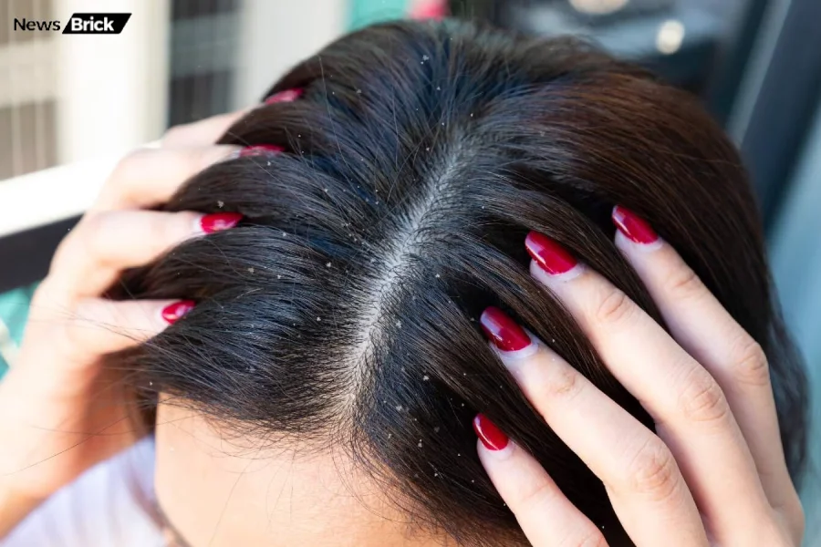 डैंड्रफ हटाने के 10 प्रभावी घरेलू उपाय - News Brick